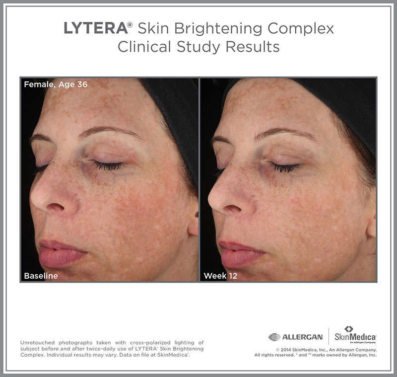LYTERA_FemaleAge36-2 - Roseville Facial Plastic Surgery