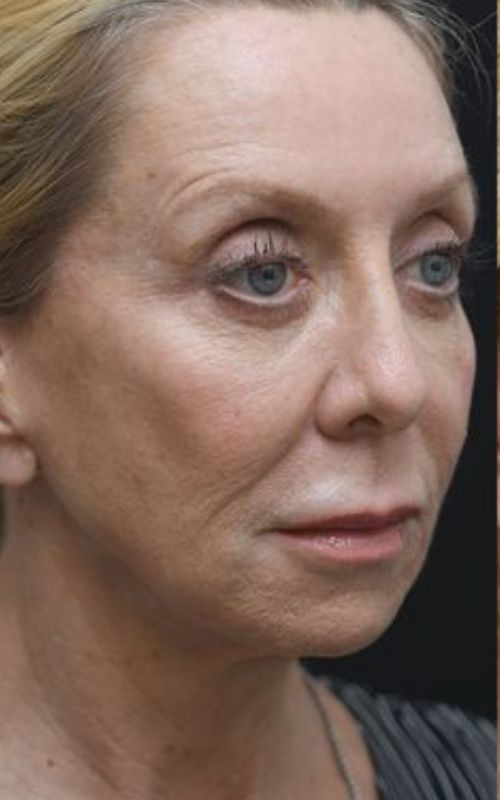 fat-injections-lip-lift-tca-peel-facelift-neck-lift-2345 - Roseville ...